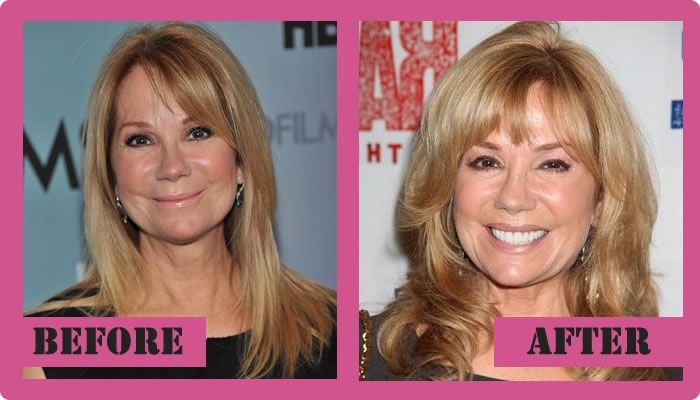 Kathie Lee Ford Plastic Surgery Before And After 3956